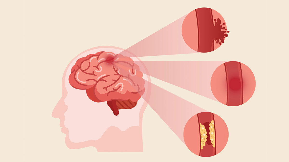 ¿Qué es el ictus? y sus consecuencias | RC Noticias